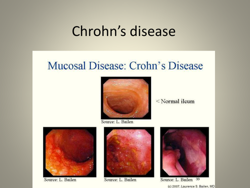 Chrohn's Disease | Teaching Resources